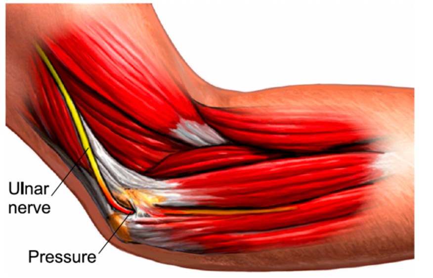 Cubital Tunnel Syndrome – Fife Virtual Hand Clinic