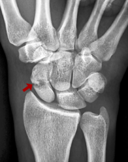 Scaphoid Fracture – Fife Virtual Hand Clinic