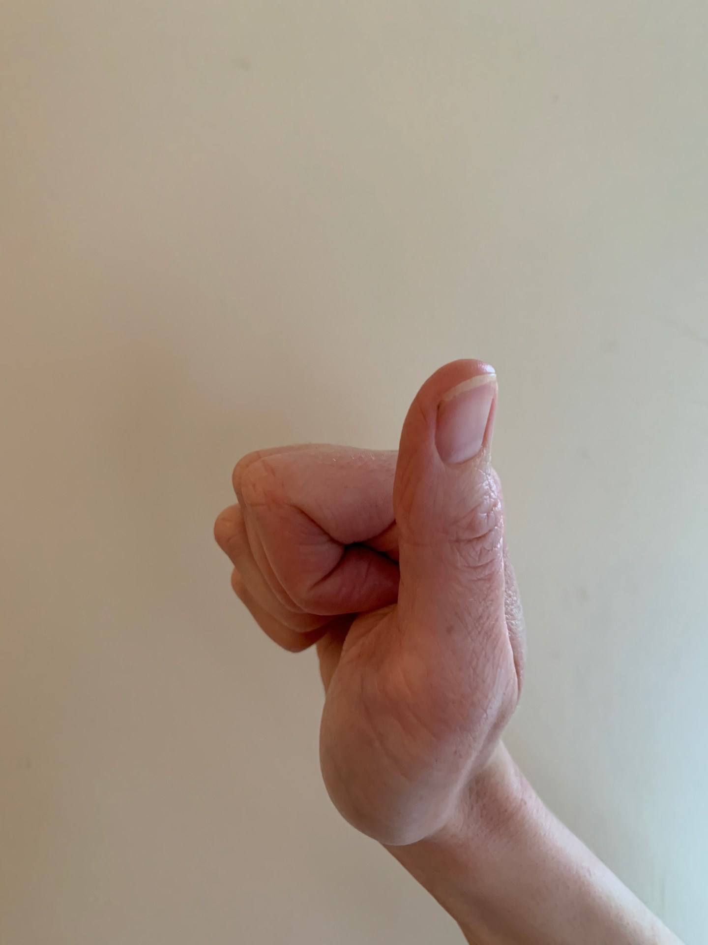Hand Fractures – Fife Virtual Hand Clinic