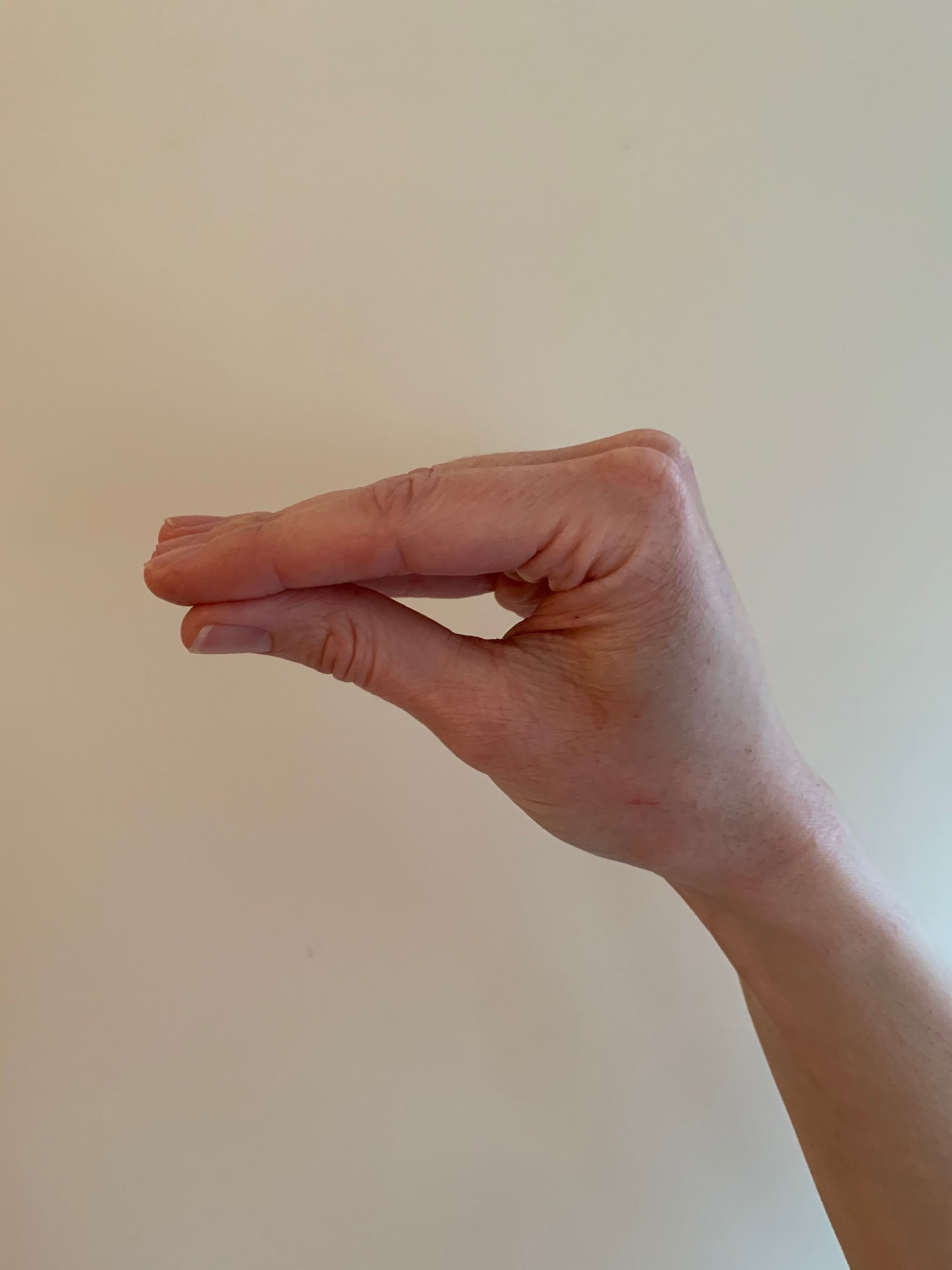 Phalangeal Fractures – Fife Virtual Hand Clinic