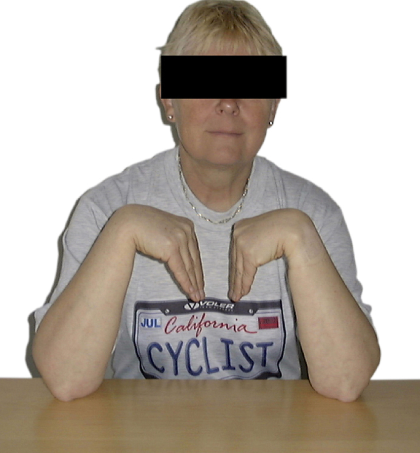 Carpal Tunnel Syndrome – Fife Virtual Hand Clinic