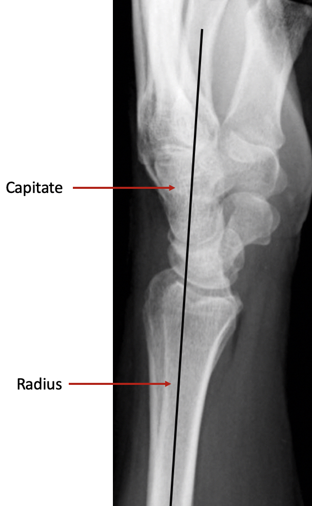 Malunion of the Distal Radius – Fife Virtual Hand Clinic