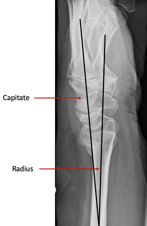 Malunion of the Distal Radius – Fife Virtual Hand Clinic