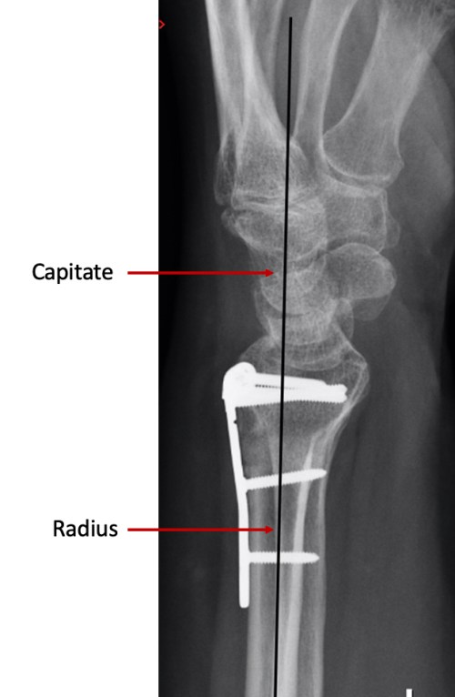 Malunion of the Distal Radius – Fife Virtual Hand Clinic