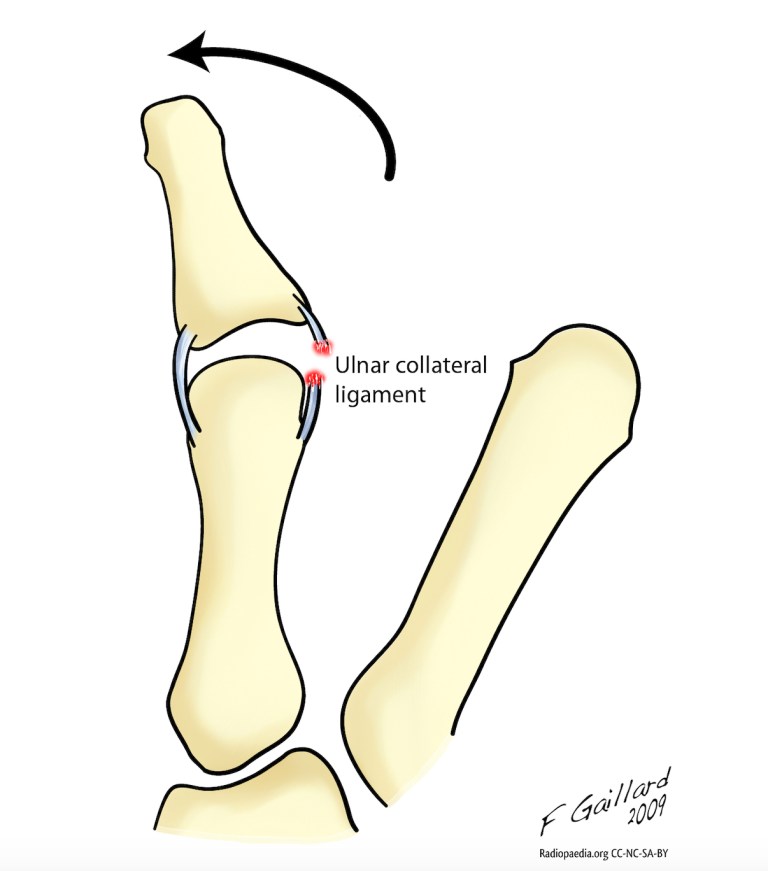 Ulnar collateral ligament (UCL) injury of thumb – Fife Virtual Hand Clinic