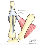 Ulnar collateral ligament (UCL) injury of thumb – Fife Virtual Hand Clinic