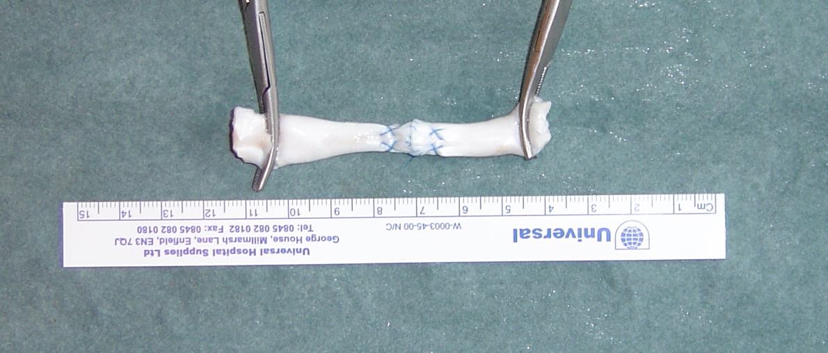 Flexor Tendon Injuries – Fife Virtual Hand Clinic