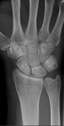 Kienbock’s Disease – Fife Virtual Hand Clinic