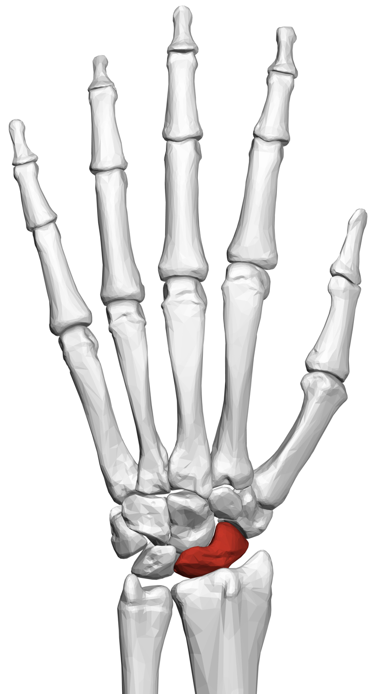 Scaphoid Non-union – Fife Virtual Hand Clinic