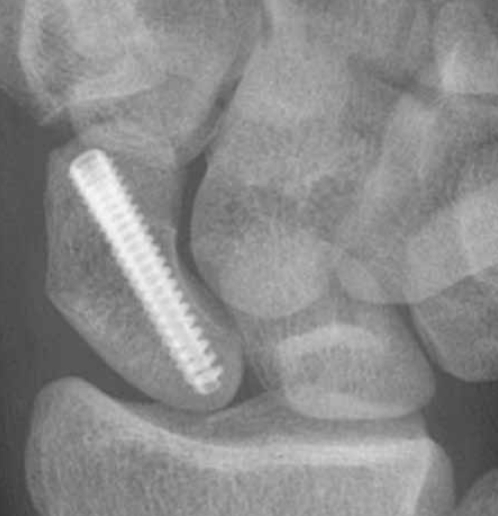 Scaphoid Non-union – Fife Virtual Hand Clinic