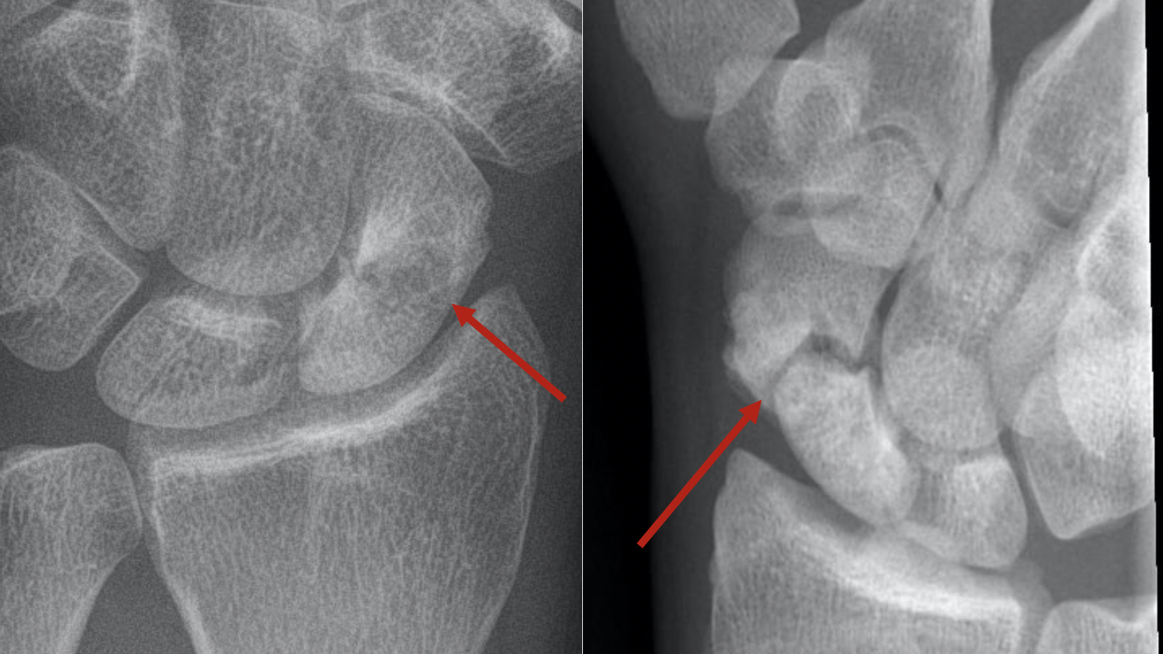 Scaphoid Non-union – Fife Virtual Hand Clinic