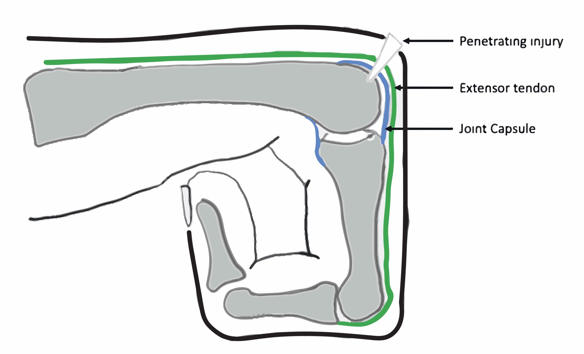 The “Fight Bite” Injury – Fife Virtual Hand Clinic