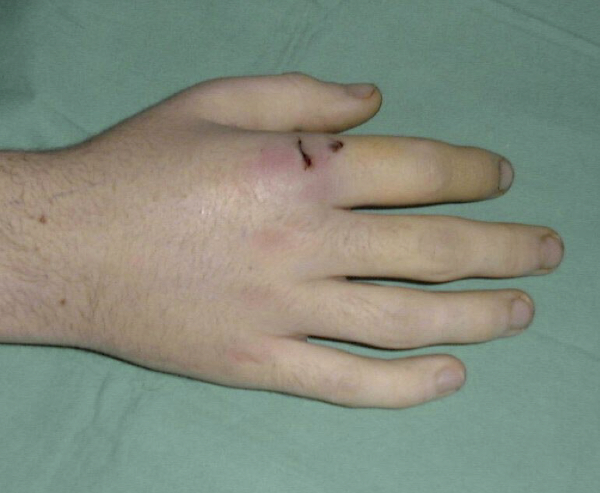 The “Fight Bite” Injury – Fife Virtual Hand Clinic
