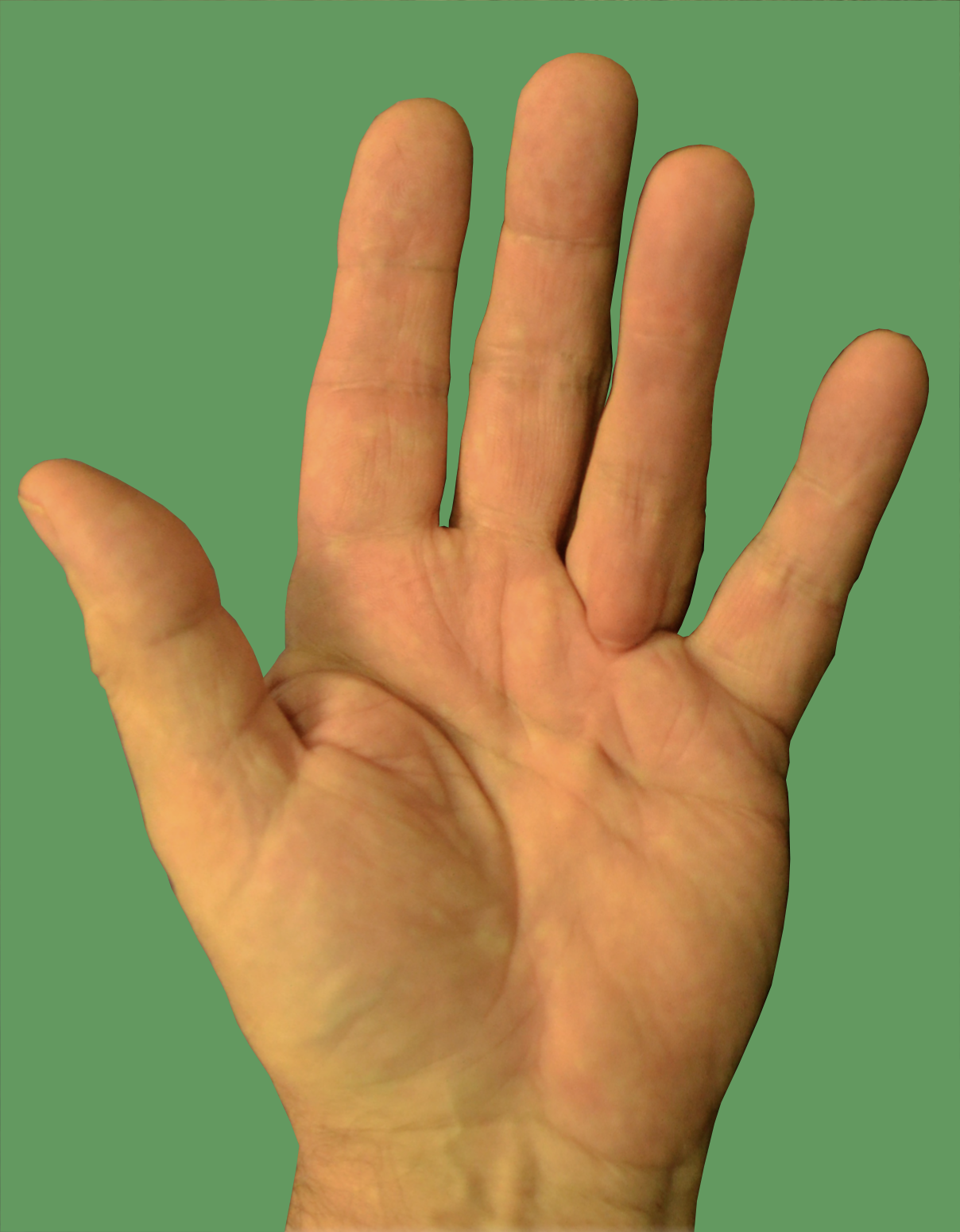 Having a Needle Fasciotomy – Fife Virtual Hand Clinic