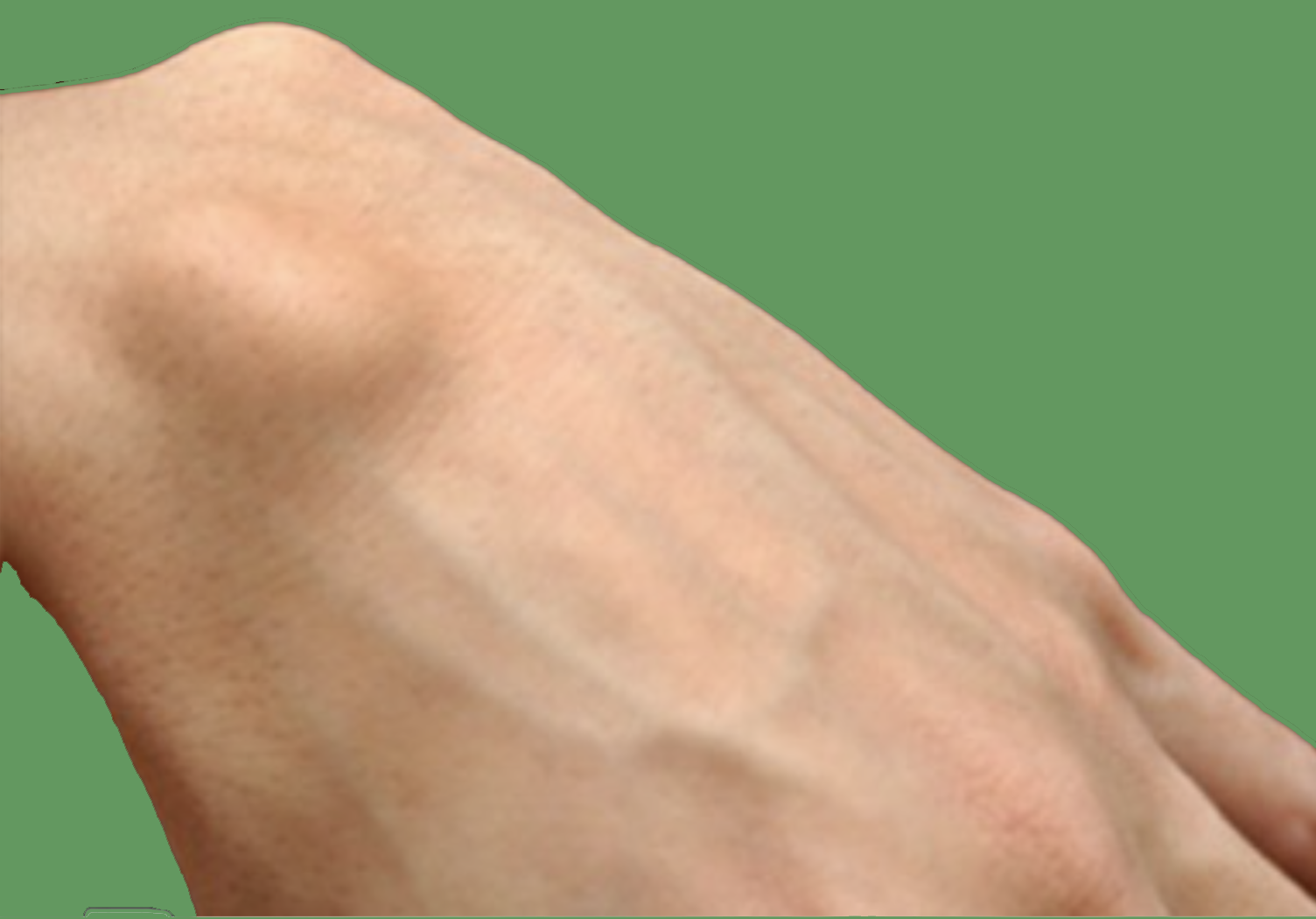 Ganglion Cysts – Fife Virtual Hand Clinic
