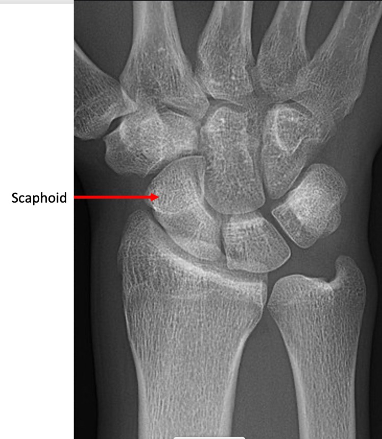 The Suspected Scaphoid Injury – Fife Virtual Hand Clinic