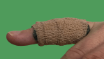Central Slip Injuries – Fife Virtual Hand Clinic