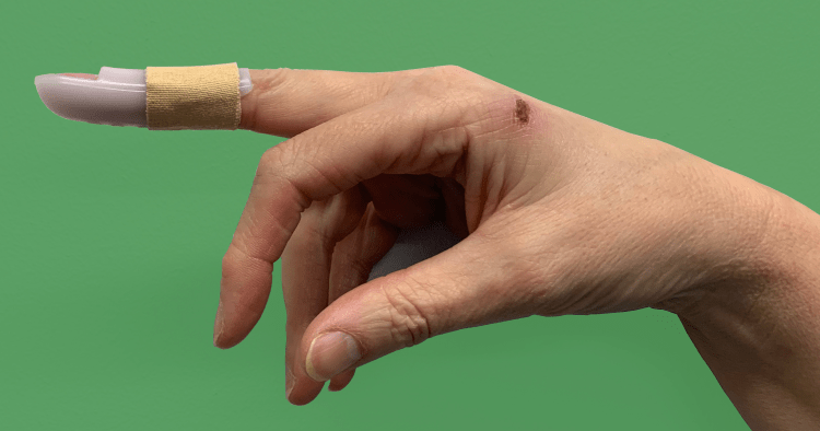 Mallet Injuries – Fife Virtual Hand Clinic