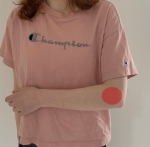 Radial Head Fractures – Fife Virtual Hand Clinic