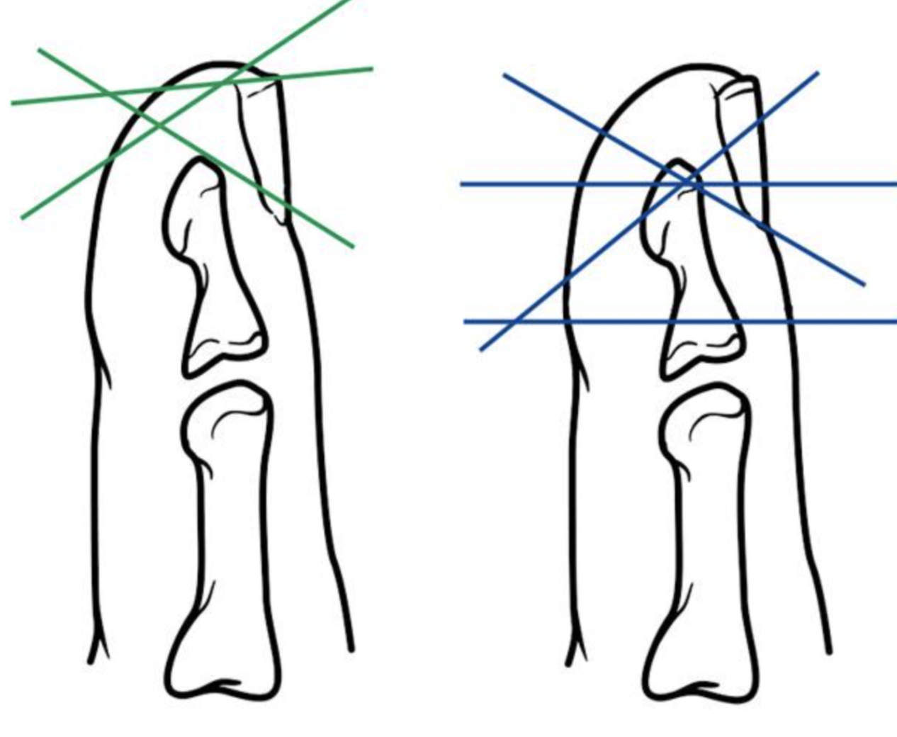 Fingertip Injuries – Fife Virtual Hand Clinic