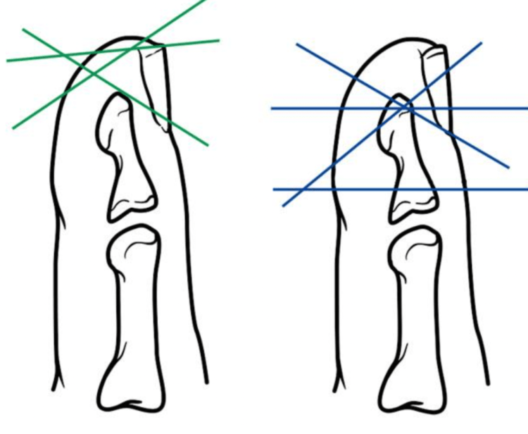 Fingertip Injuries – Fife Virtual Hand Clinic