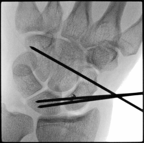 Scapholunate ligament Injuries – Fife Virtual Hand Clinic