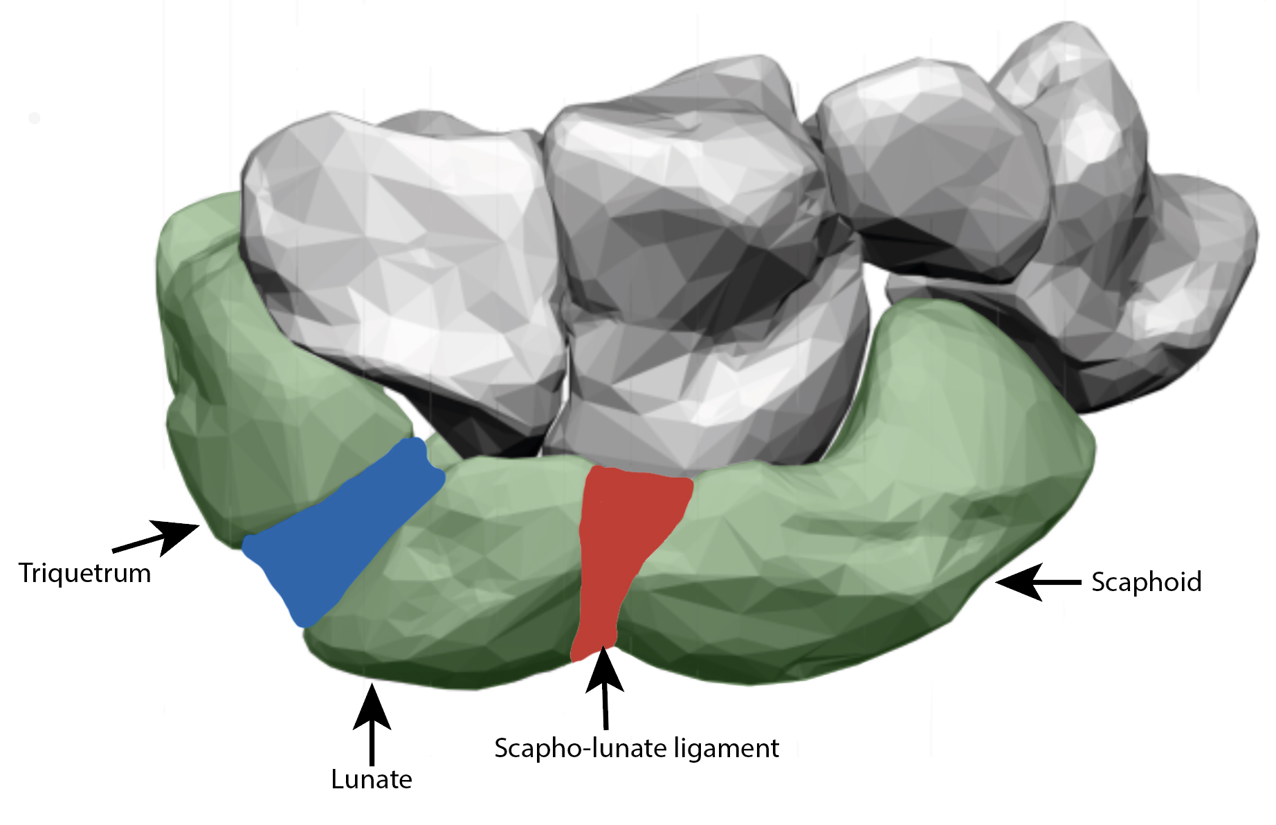 Scapholunate ligament Injuries – Fife Virtual Hand Clinic
