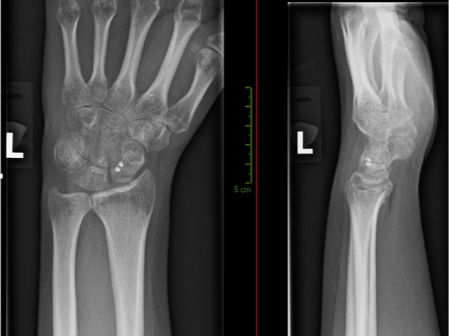 Scapholunate ligament Injuries – Fife Virtual Hand Clinic