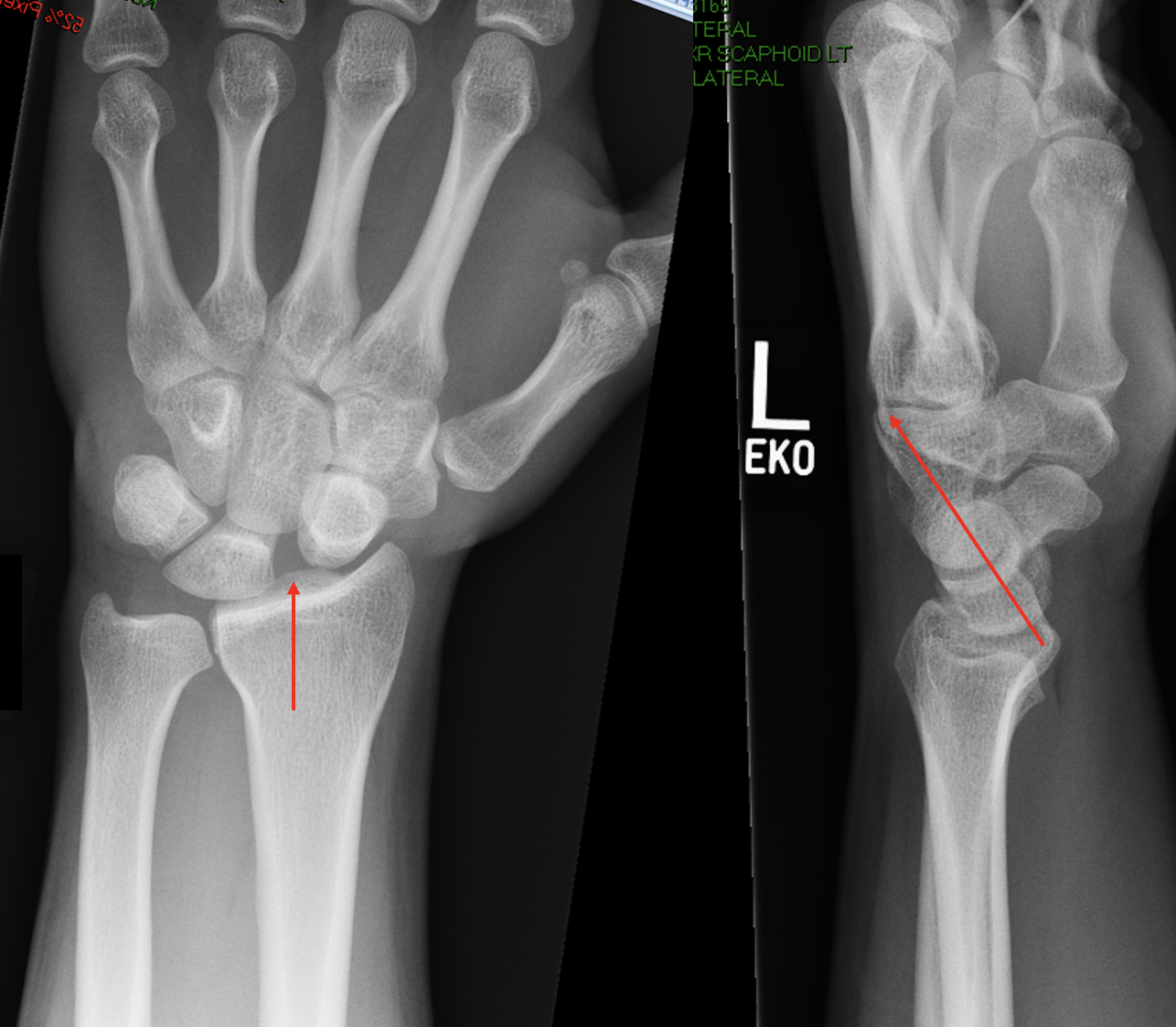Scapholunate ligament Injuries – Fife Virtual Hand Clinic