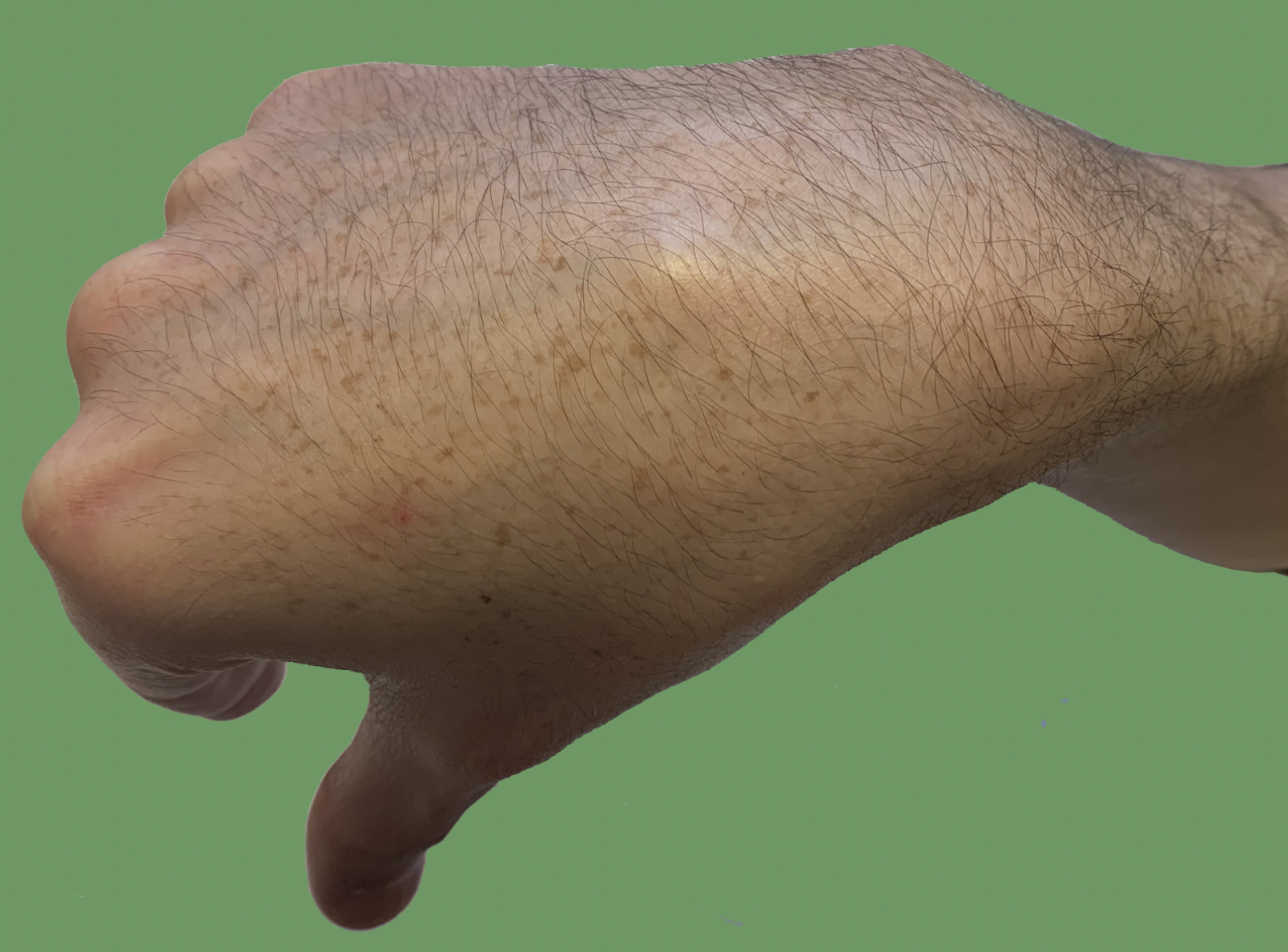 Carpal Boss – Fife Virtual Hand Clinic