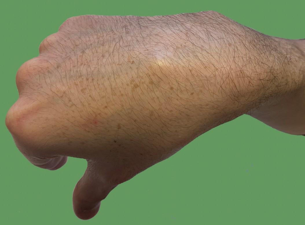 Carpal Boss – Fife Virtual Hand Clinic