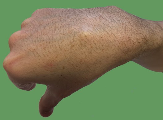 Carpal Boss – Fife Virtual Hand Clinic