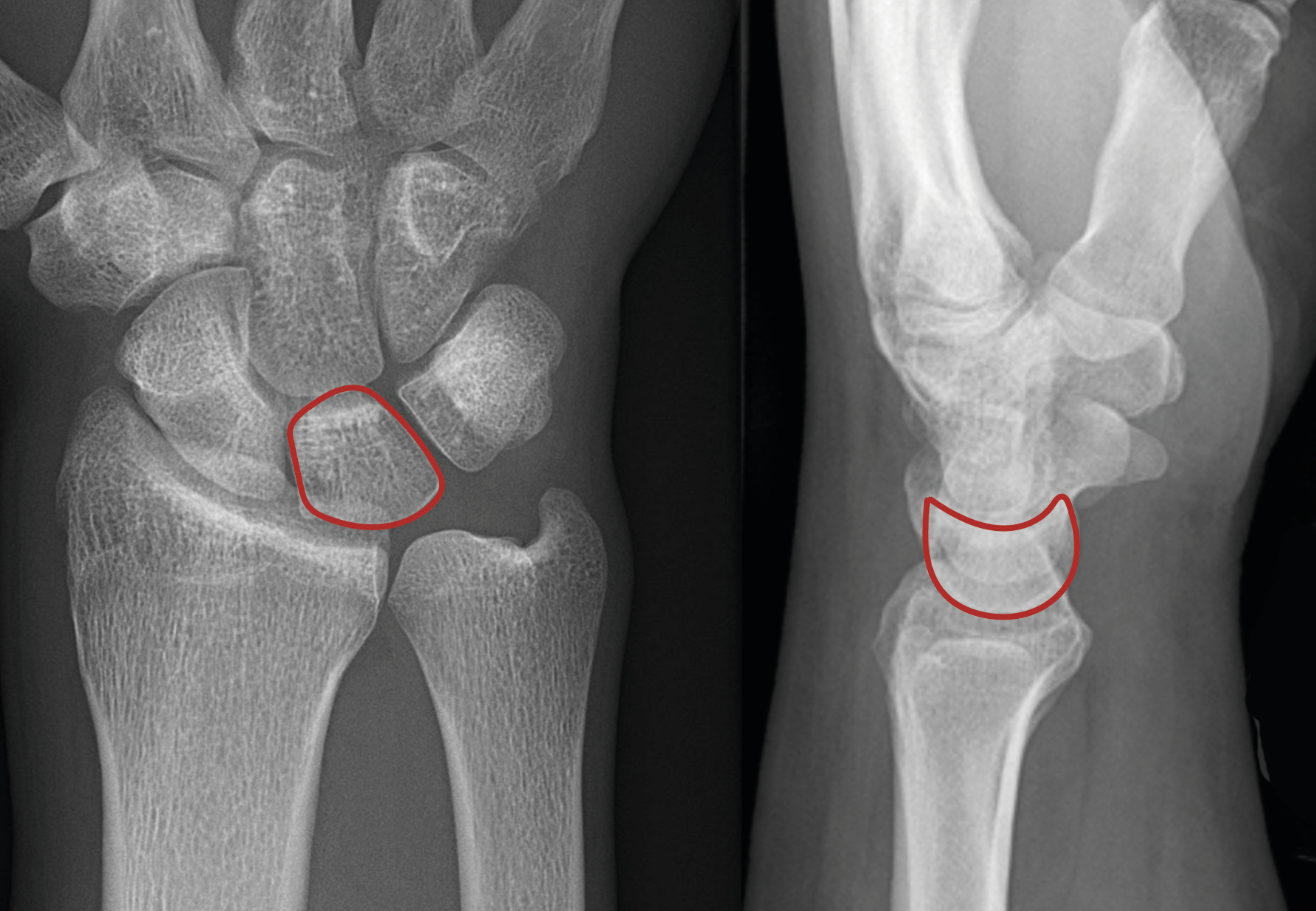 Perilunate Dislocation of the Wrist – Fife Virtual Hand Clinic