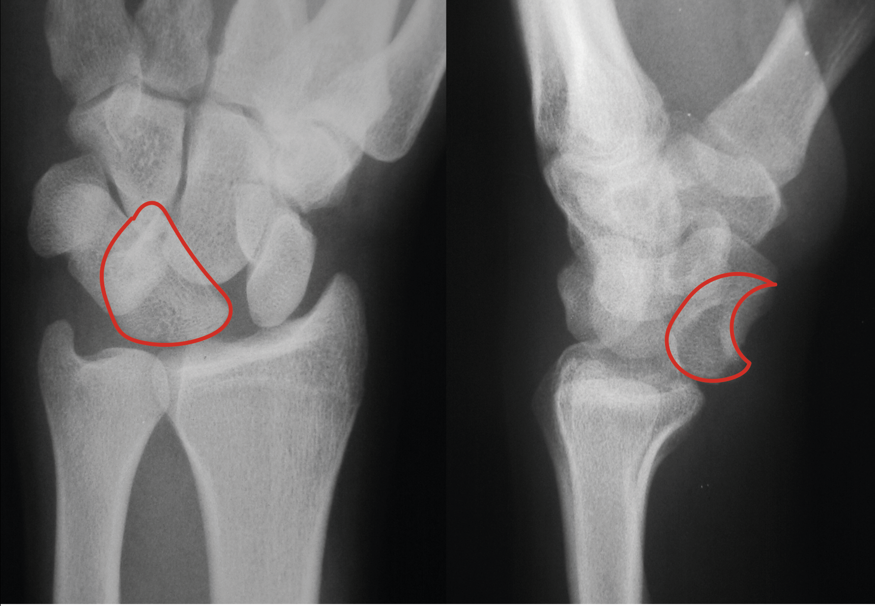 Perilunate Dislocation of the Wrist – Fife Virtual Hand Clinic