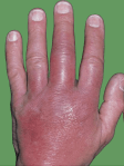 Infection around the Hand and Wrist – Fife Virtual Hand Clinic