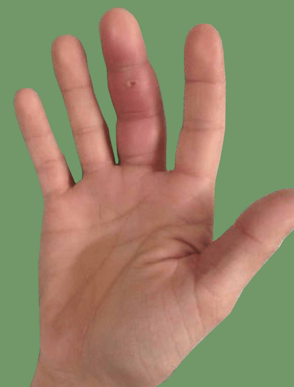 Infection around the Hand and Wrist – Fife Virtual Hand Clinic