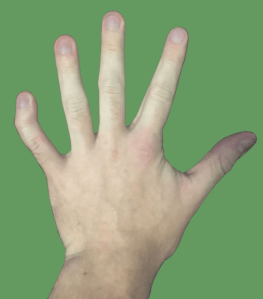 Little fingers, little problems! – Fife Virtual Hand Clinic