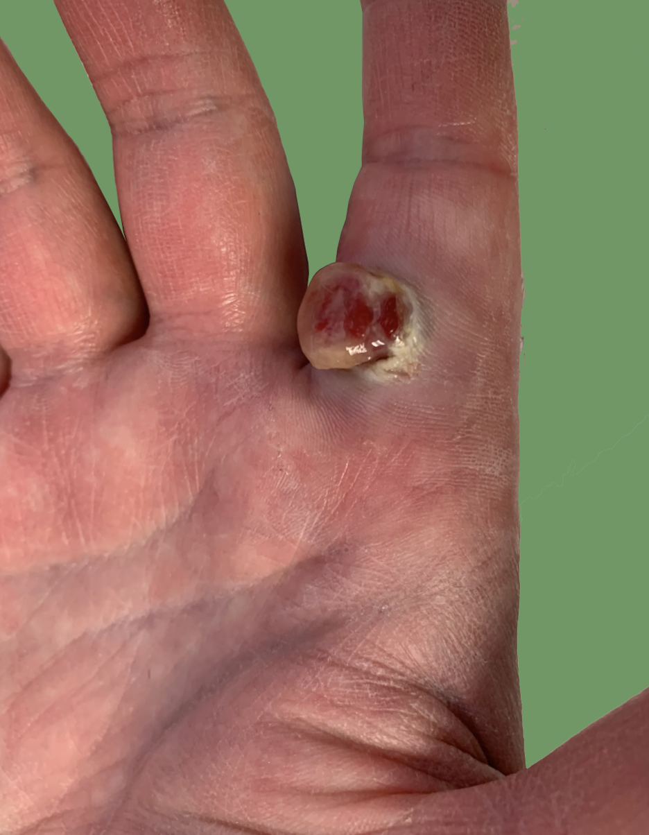 Lumps and Bumps around the Hand and Wrist – Fife Virtual Hand Clinic