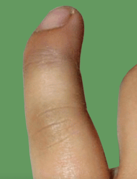 Little fingers, little problems! – Fife Virtual Hand Clinic
