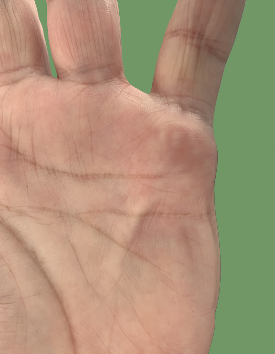 Lumps and Bumps around the Hand and Wrist – Fife Virtual Hand Clinic
