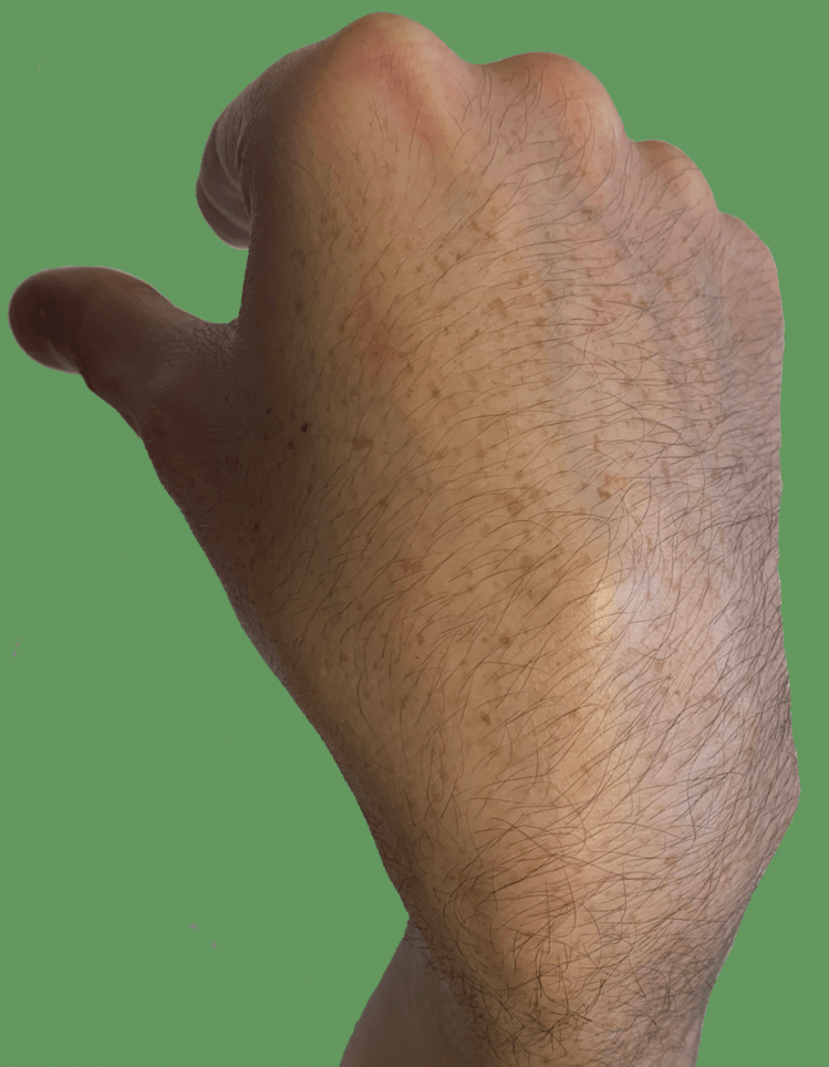 Lumps and Bumps around the Hand and Wrist – Fife Virtual Hand Clinic