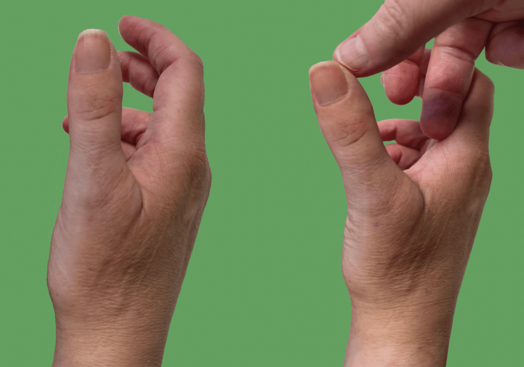 Ulnar collateral ligament (UCL) injury of thumb – Fife Virtual Hand Clinic