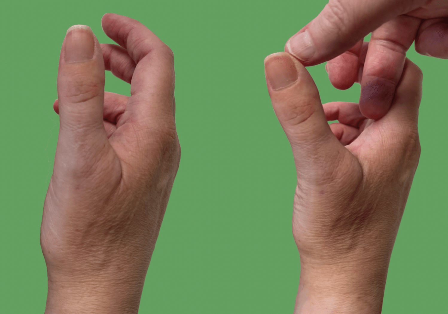 Ulnar collateral ligament (UCL) injury of thumb – Fife Virtual Hand Clinic