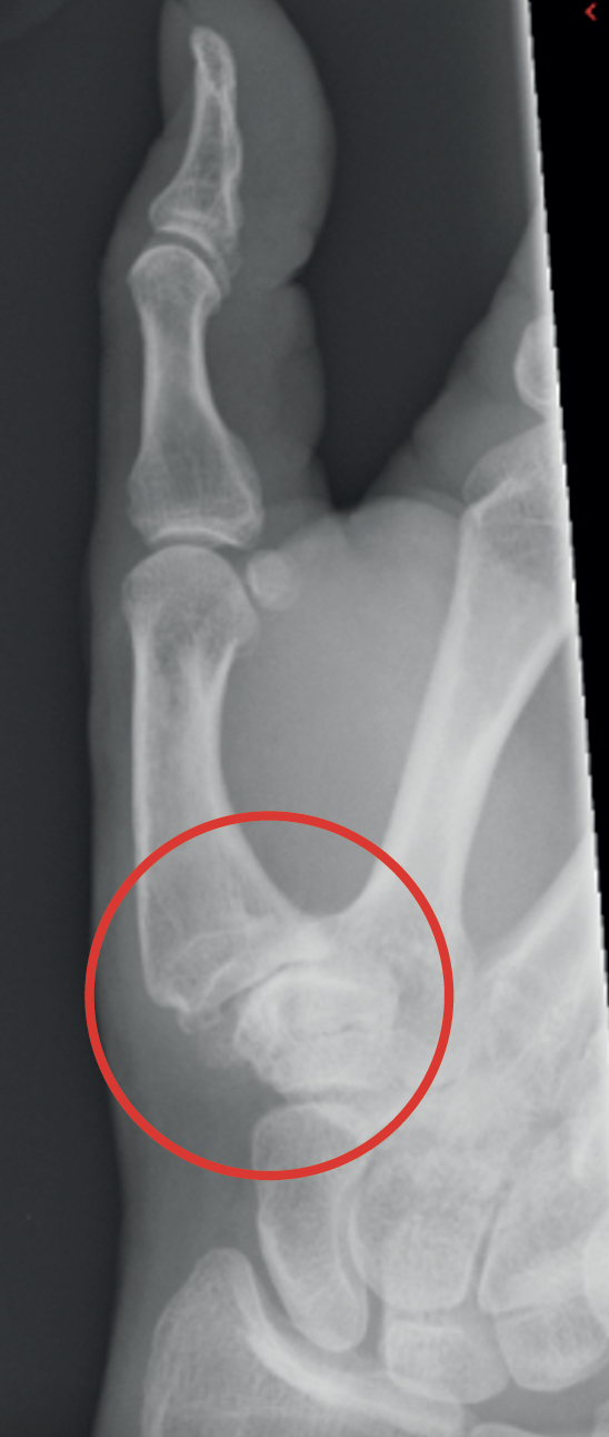 Base of Thumb Arthritis – Fife Virtual Hand Clinic