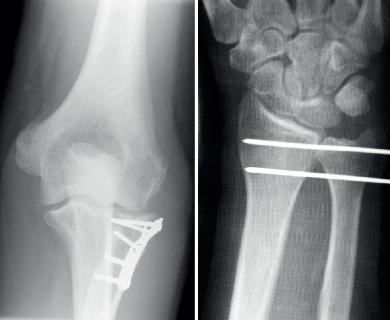 The Essex Lopresti Injury – Fife Virtual Hand Clinic