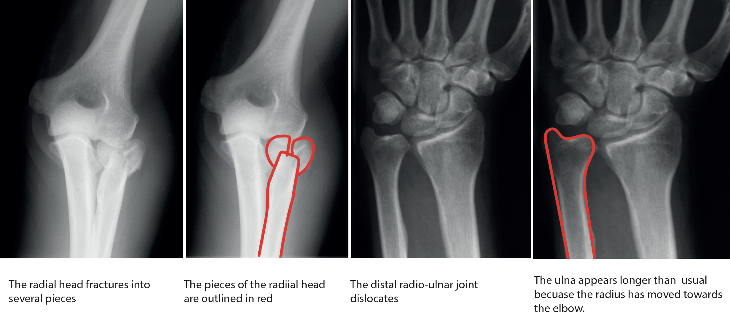 The Essex Lopresti Injury – Fife Virtual Hand Clinic