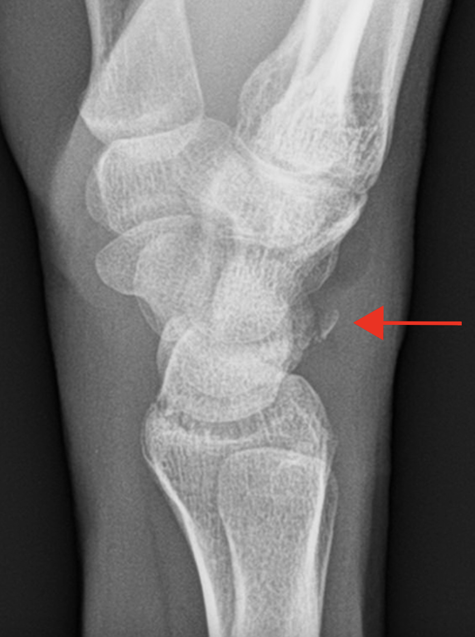 Avulsion Fractures of the Triquetrum – Fife Virtual Hand Clinic
