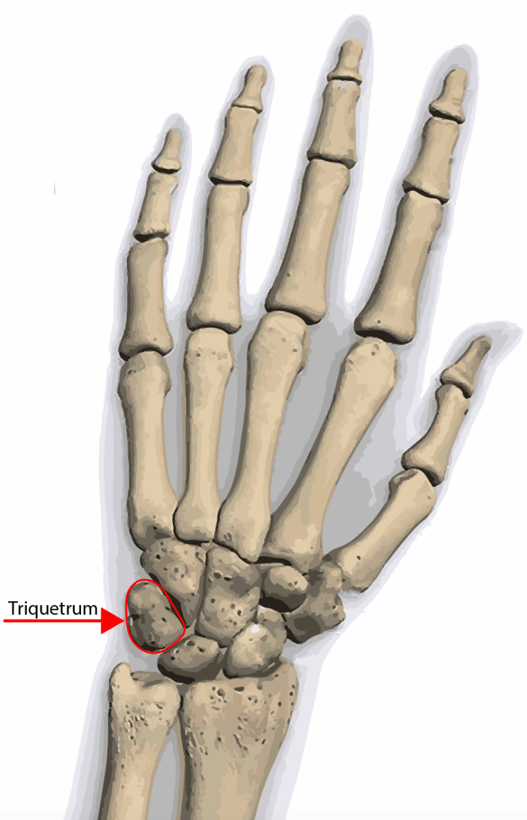 Avulsion Fractures of the Triquetrum – Fife Virtual Hand Clinic