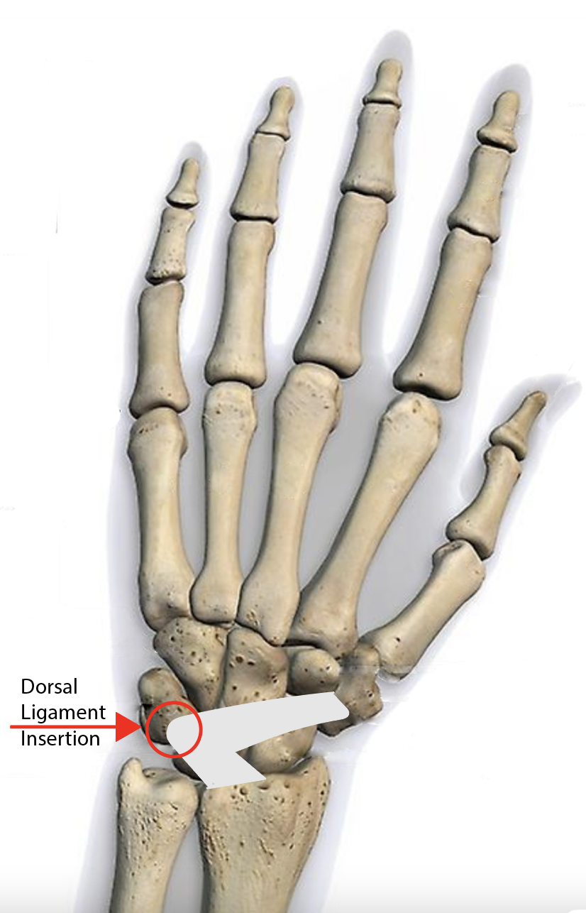 Avulsion Fractures of the Triquetrum – Fife Virtual Hand Clinic