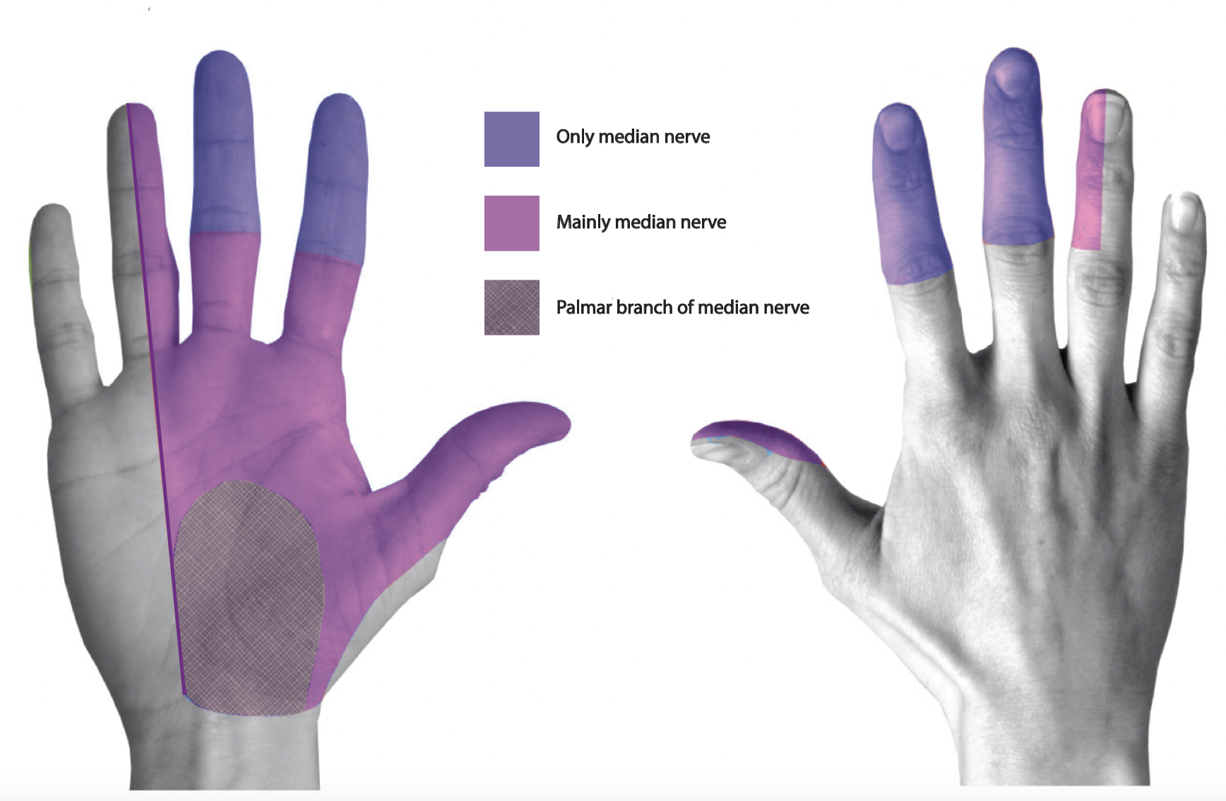 Carpal Tunnel Syndrome – Fife Virtual Hand Clinic